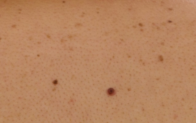 Histología Del Nevus Melanocítico